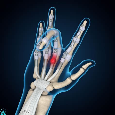 Trigger Finger D Rendering Finger Anatomy Hand Anatomy ExerciseNow