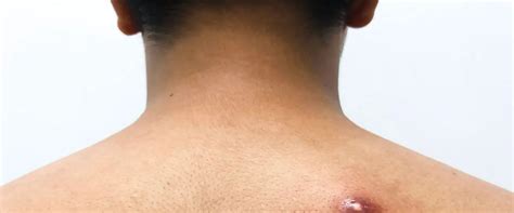 Boil Vs Cyst Vs Abscess Spot Treat And Heal Fast