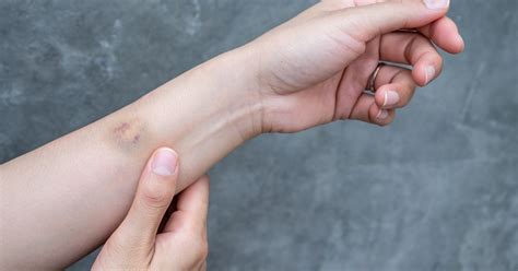 Wat Is Een Hematoom En Wanneer Is Dit Gevaarlijk Margriet