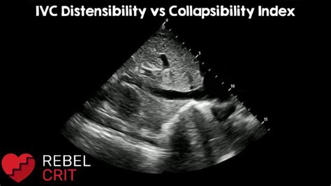 Ivc Distensibility Index Vs Collapsibility Index Using The Correct