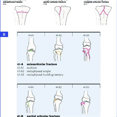 A B Proximal Tibial Ao Ota Classification Download Scientific Diagram