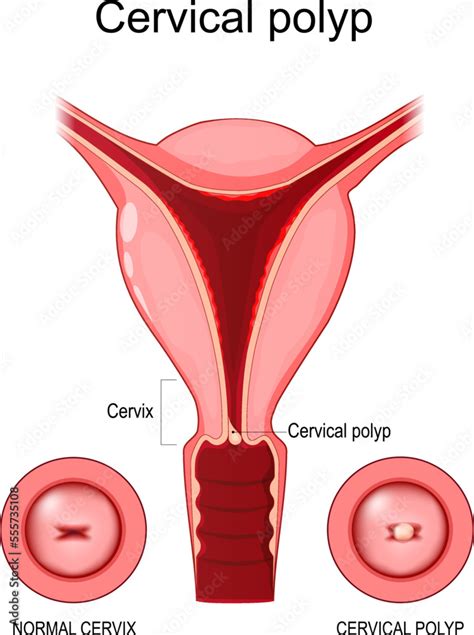 Cervical Polyp Normal Cervix And Benign Tumor On The Surface Of The