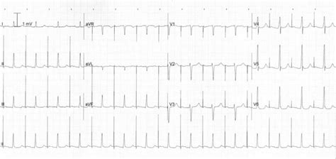 Pacemaker Rhythms Normal Patterns LITFL ECG Library Diagnosis