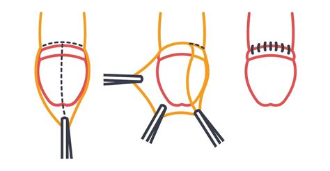 Serbisyo Ng Pagtutuli Assure Urology