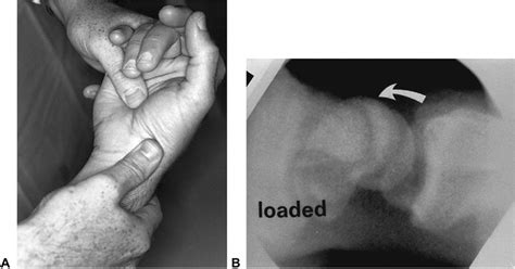 A During The Performance Of The Scaphoid Shift Test The Examiner