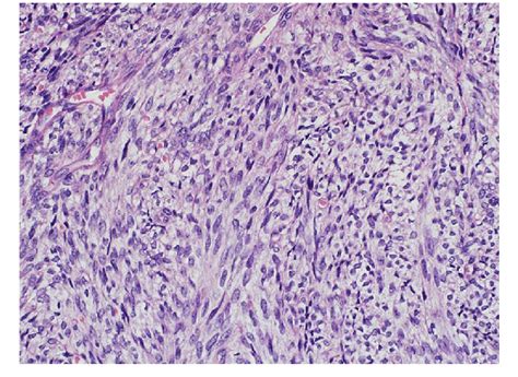 Keytruda Spindle Cell Sarcoma At Ryan Knight Blog