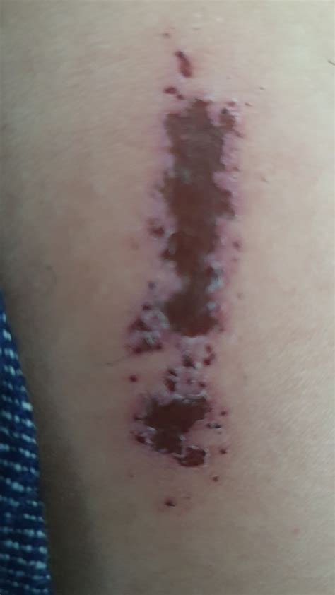 다리 상처질문 지식in