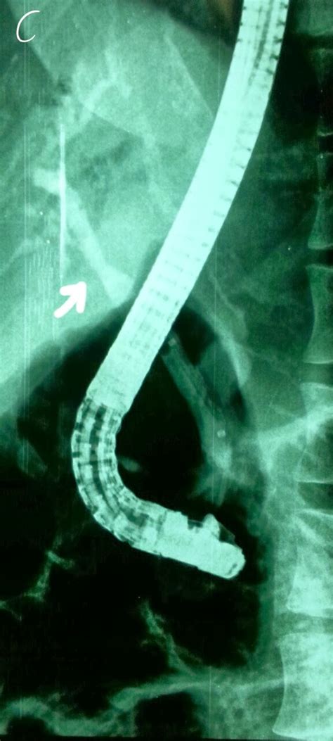 Ercp And Egd Fourth Follow Up Ercp For A Post Cholecystectomy Cbd Stricture