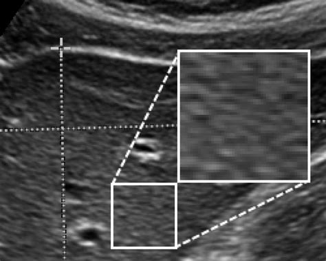 Comparison Of Proposed Despeckling Techniques For Non Ultrasound