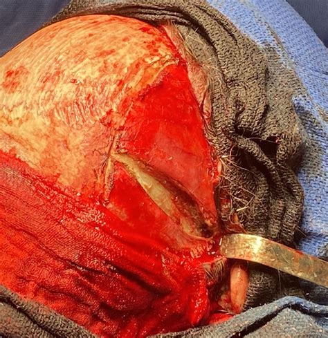 The Temporal Reduction Head Narrowing Surgery Exposed Explore Plastic