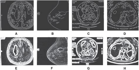 Edge Detection Algorithms For Boundary Detection In Medical Images Download Scientific Diagram