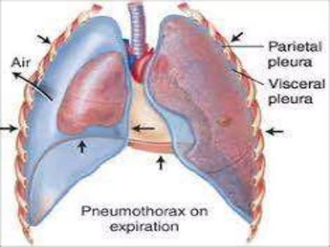TOPIC OF PNEUMOTHOREX Pptx