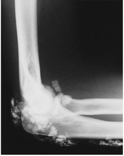 Skeletal And Extraskeletal Calcification And Ossification Syndromes Basicmedical Key