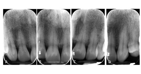A Gingivectomy Procedure Using A Diode Laser Decisions In Dentistry