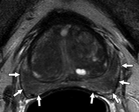 What Is A Multiparametric Mri Prostate At Timothy Gordon Blog