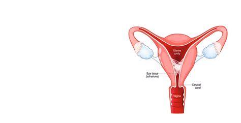 Ashermans Syndrome Ashermans Disease Symptoms And Treatments