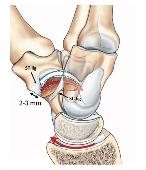 The Amount Of Bone Resection Of The Scaphoid Head Red Arrows Denote