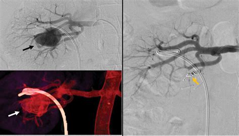 Catheter Angiography Black Arrow And Computed Tomography