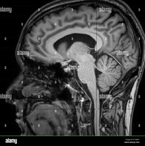 Transverse Plane Brain