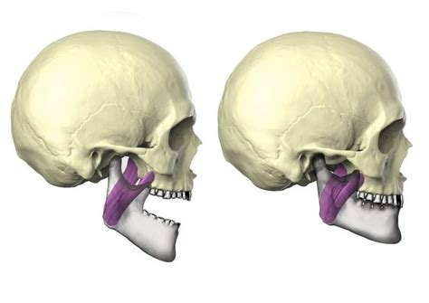 Medial Pterygoid Muscle Origin Insertion Function Exercise