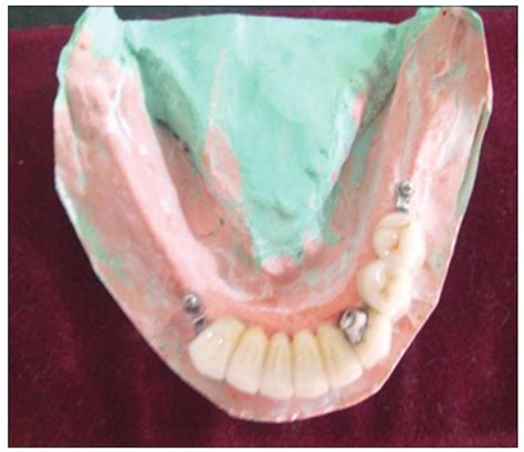 Figure 7 From Attachment Retained Cast Partial Denture