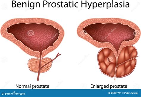 Benign Prostatic Hyperplasia Stock Vector Illustration Of Enlarged Cancer 25197741