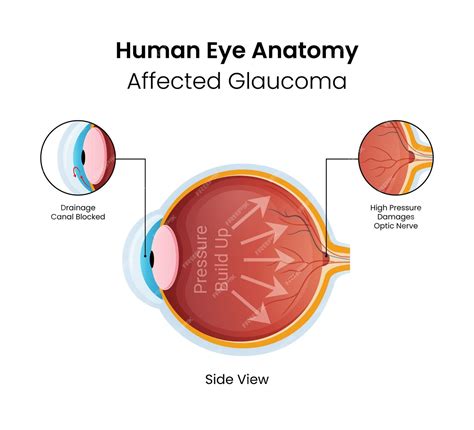 Premium Vector Human Eye Anatomy Affected Glaucoma