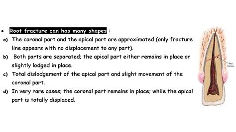 Horizontal Fracture Pdf
