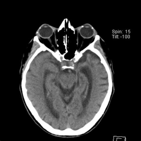 Calcification Of The Globe Differential Pacs
