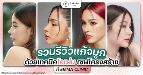 ทำไมใคร ๆ ก็อยากได้ทรงจมูกสโลปปลายพุ่ง เสริมจมูกแบบโอเพ่น