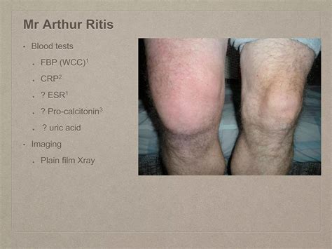 Arthrocentesis Pptx Bone And Joint Conditions Diseases And Conditions