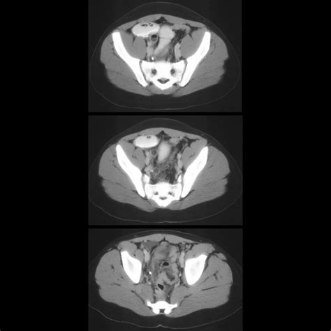 Pediatric Appendicitis Pediatric Radiology Reference Article