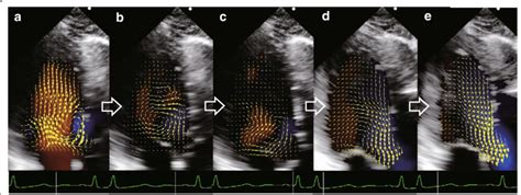 Example Of A Vector Flow Mapping Image Of A Healthy Volunteer A The
