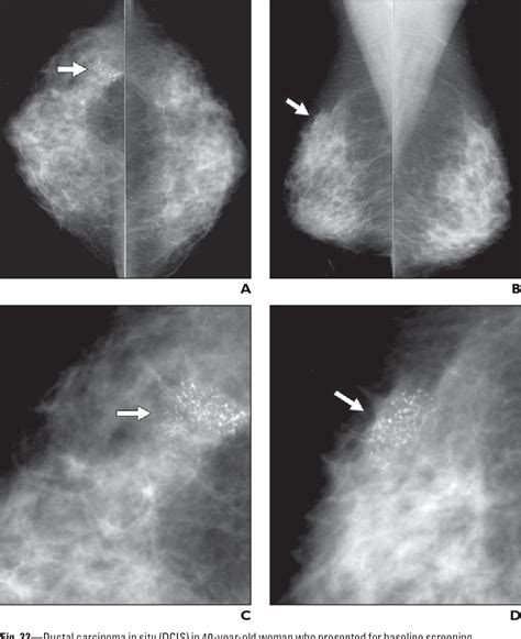 Figure 16 From Breast Calcifications The Focal Group Semantic Scholar