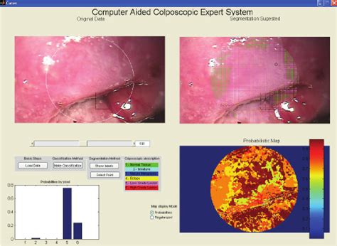 Colposcopic Image Segmentation The Image At The Left Shows The Download Scientific Diagram