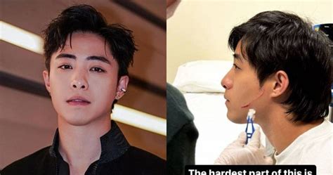 My Face Felt Hot Zong Zijie Suffers 10cm Cut On Cheek While Filming Drama Entertainment News