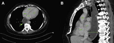 Figure 1 From Left Atrial Compression After Laparoscopic Gastric Banding Semantic Scholar