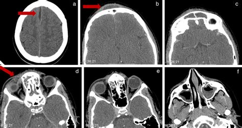 Ct Scan Of Brain Orbits And Paranasal Sinuses A Subdural And