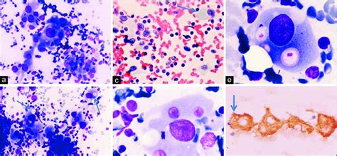 Hashimoto Thyroiditis Ht With Colloid Inclusions Cis A A Group Download Scientific