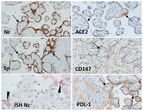 Placenta Showed Focal Expression Of Sars Cov 2 Nucleocapsid Nc And