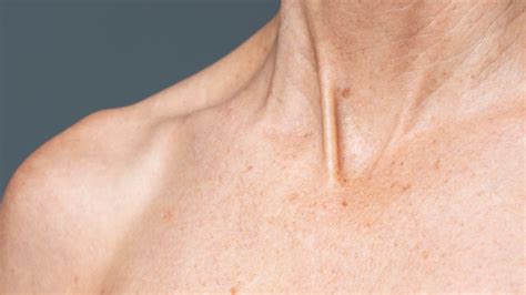 Hipercromia O Que É E Melhores Ativos Para Tratar