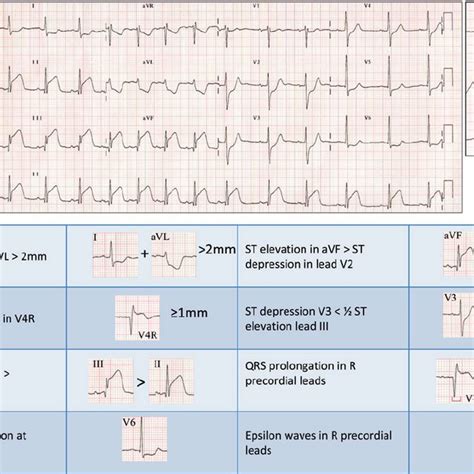 Pdf Right Ventricular Myocardial Infarction Pathophysiology
