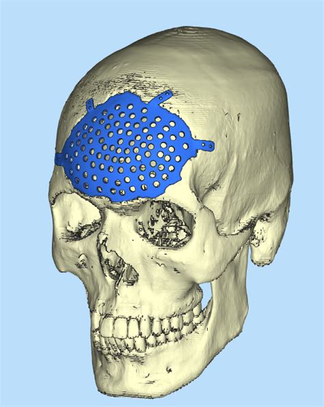 Stl File Cranial Plate Made According To Defect・3d Printable Design To