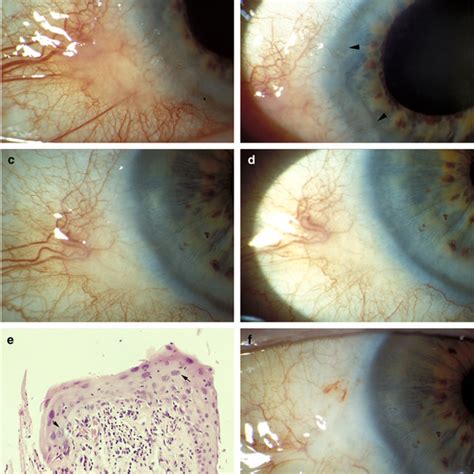 Pdf Neoadjuvant Topical Mitomycin C Chemotherapy For Conjunctival And Corneal Intraepithelial