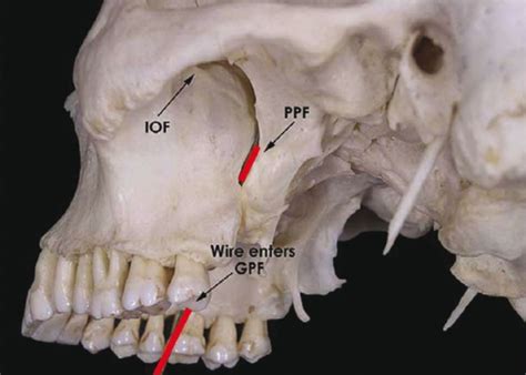 Maxillary Nerve Block High Tuberosity Approach