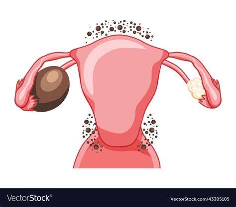 Ovarian Endometriomas Chocolate Cysts Female Vector Image