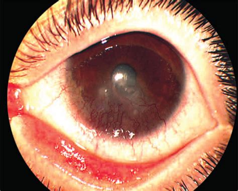 Phlyctenular Keratitis Lichen Scrofulosorum And Phlyctenular