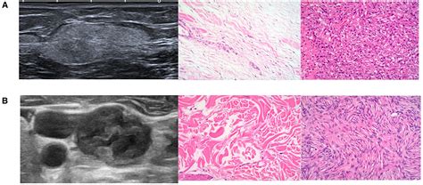 Frontiers Exploring The Correlation Of Radiomic Features Of Ultrasound Images And Fnclcc
