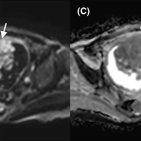 Images In A Patient With An Exophytic Tumor Located At The Bladder