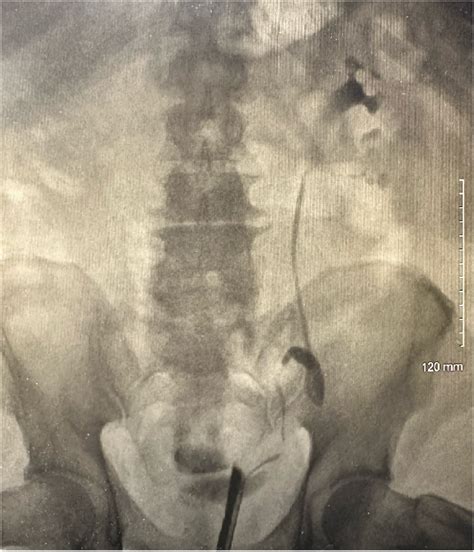 Initial Intraoperative Retrograde Pyelogram Showing The Left Looping